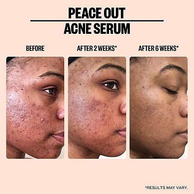 Peace Out Salicylic Acid Acne Treatment Serum